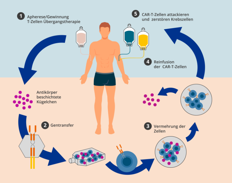 CAR-T-Therapie Essen – Zelltherapie bei Blutkrebs